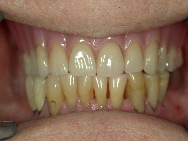 Our Work | Turner Dental Laboratory, Victoria BC